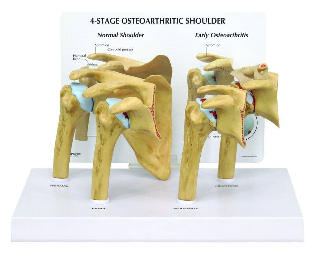 Educational Model Set Shows Stages of Shoulder Osteoarthritis ...